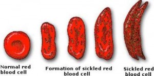 10 Interesting Sickle Cell Anemia Facts | My Interesting Facts